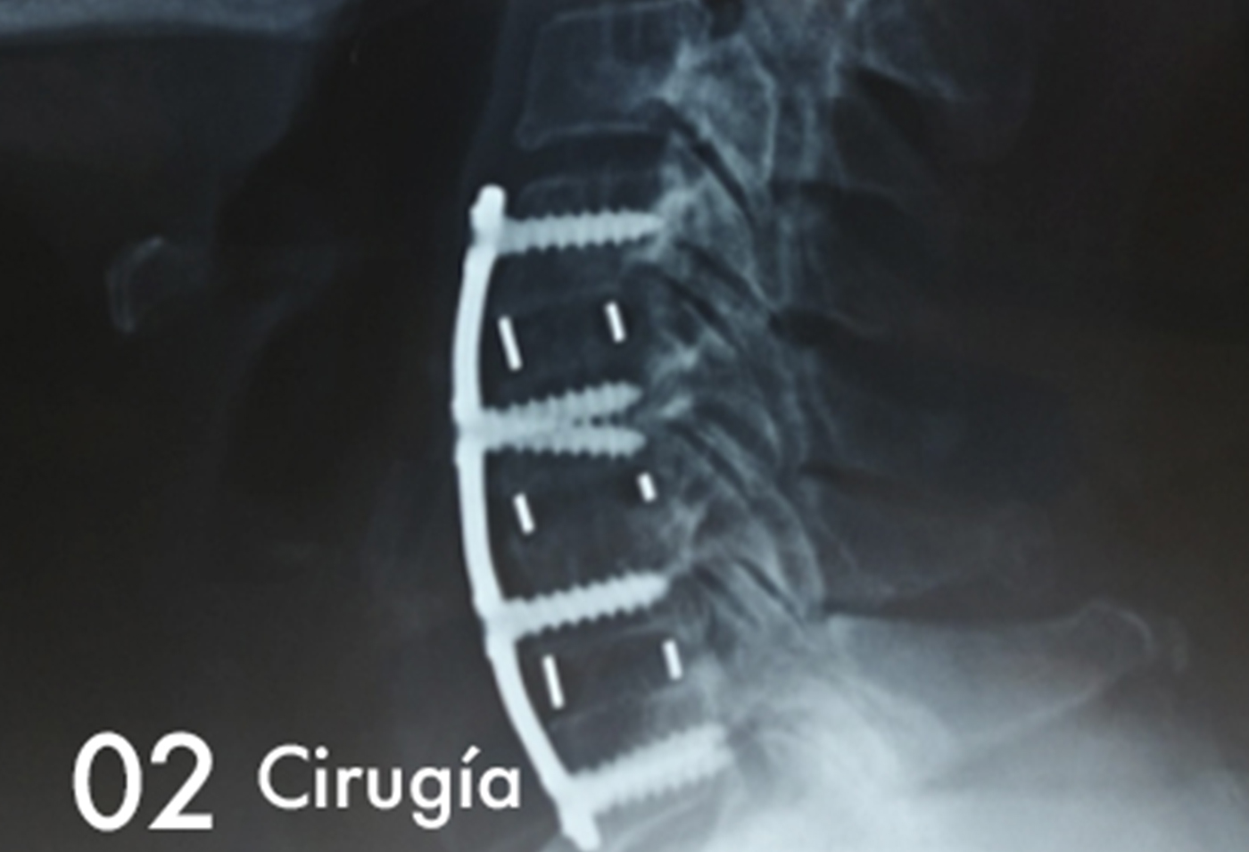 SIC Medical | Hernia de disco cervical · Discectomía